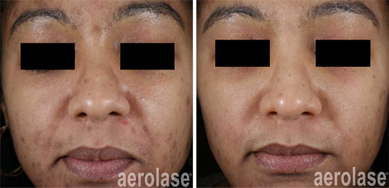 Skin Rejuvenation Sacramento | Aerolase Neo Elite Roseville