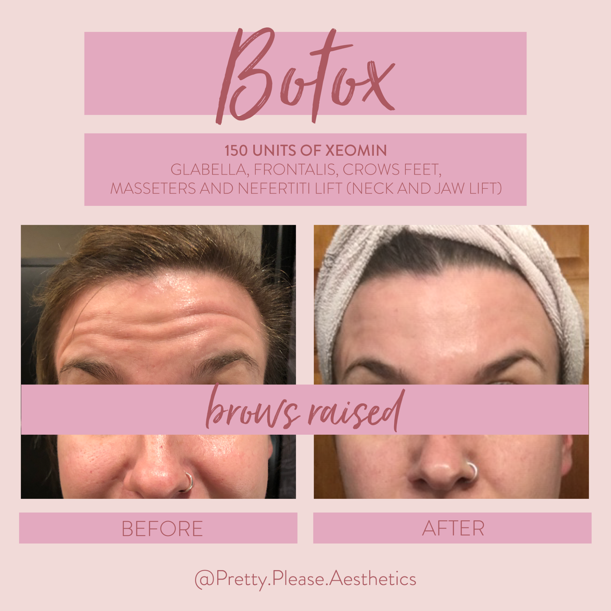 The Neuromodulators Botox Xeomin And Dysport Blog Pretty Please